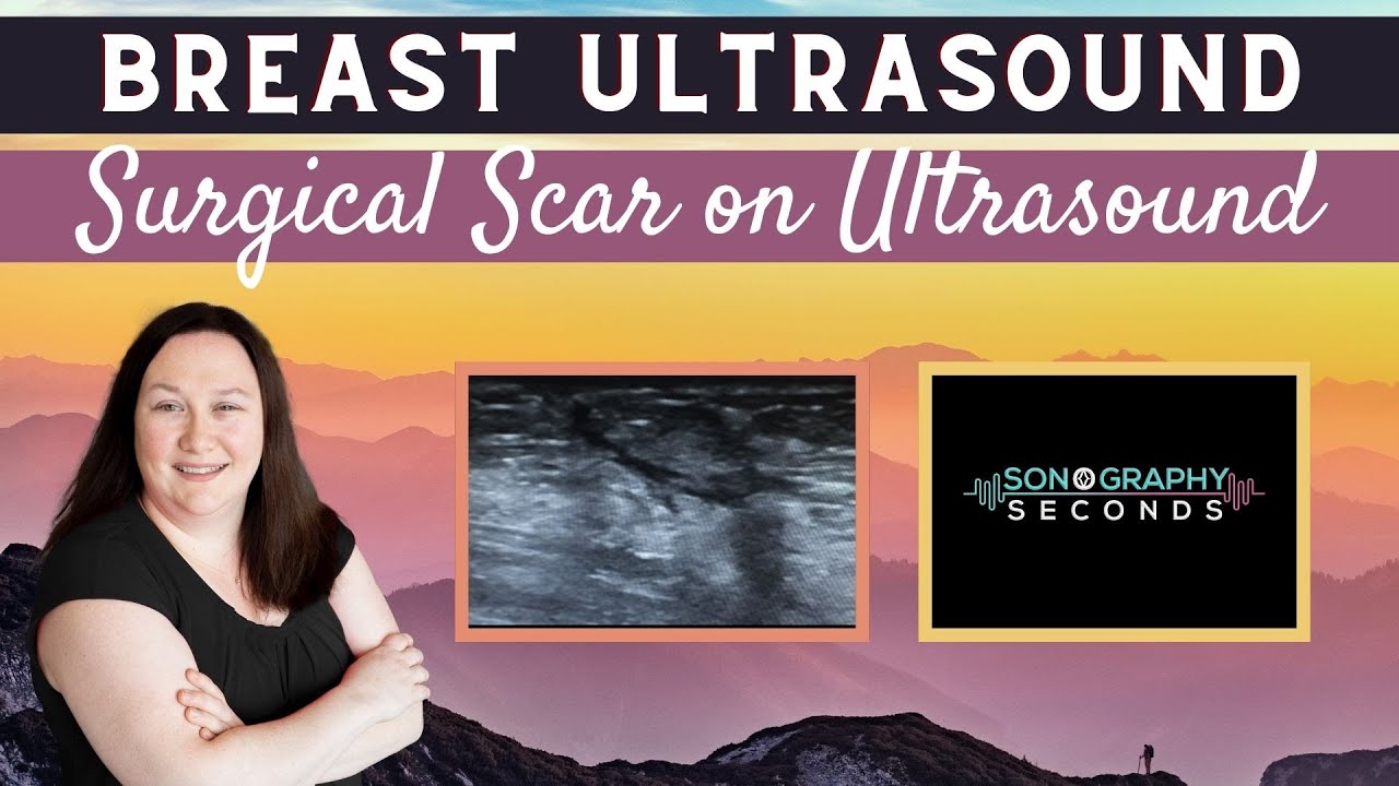 Breast Ultrasound Appearance Of A Surgical Scar On Ultrasound Youtube