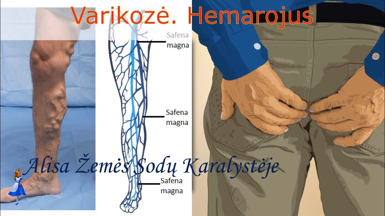 Varikoze. Hemarojus. - YouTube
