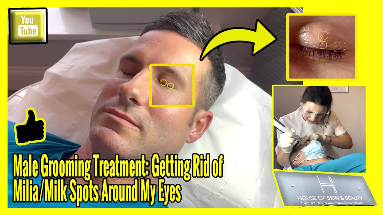 Male Grooming Treatment: Getting Rid of Milia/Milk Spots Around My Eyes ...