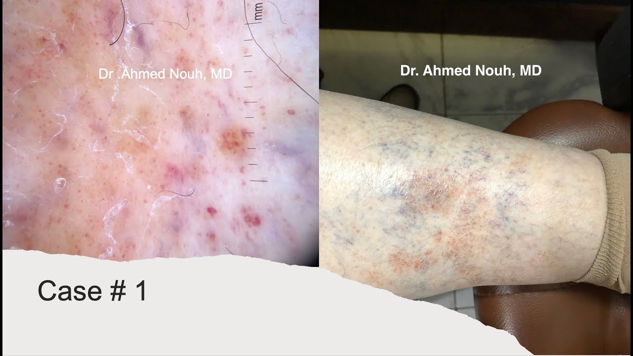 Pigmented purpuric dermatoses (Dermatological spectra) - YouTube