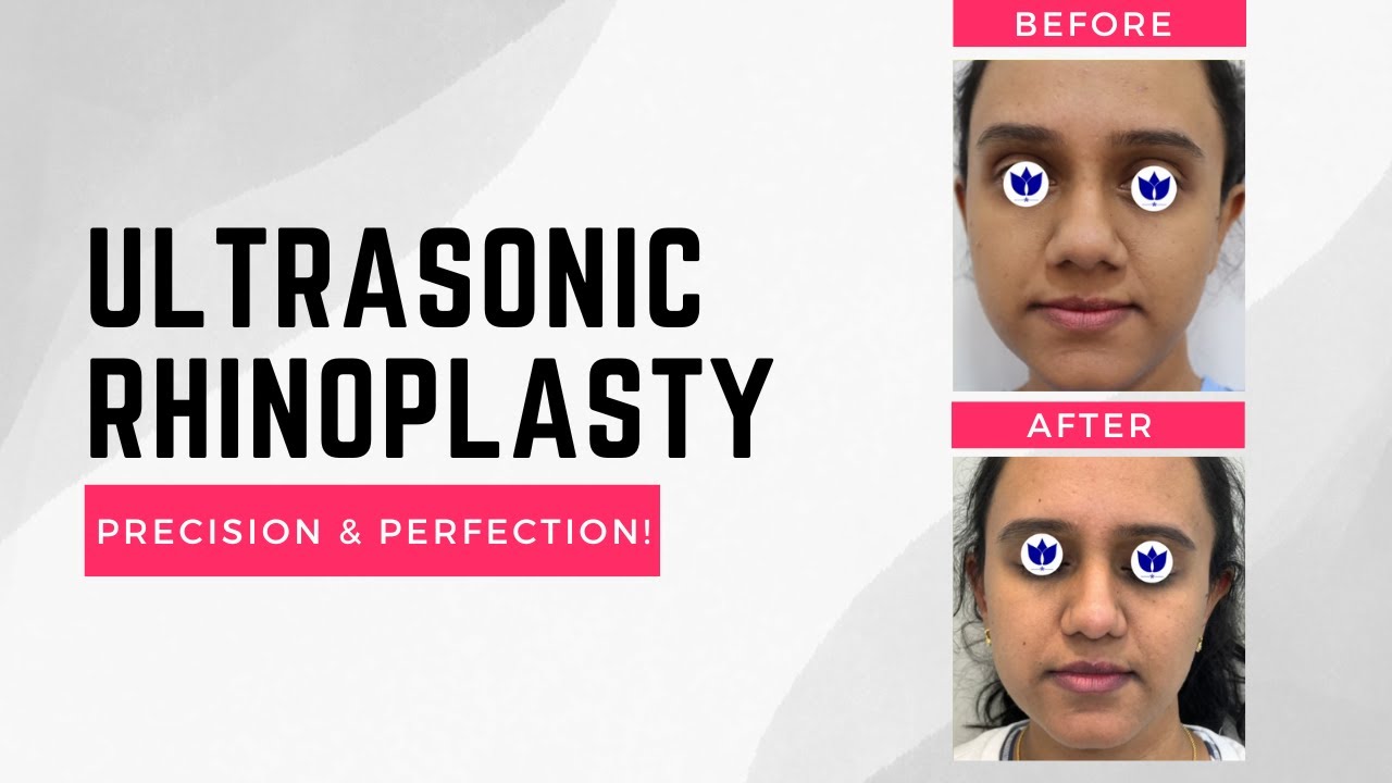 Ultrasonic Rhinoplasty: A Natural and Precise Nose Transformation - YouTube