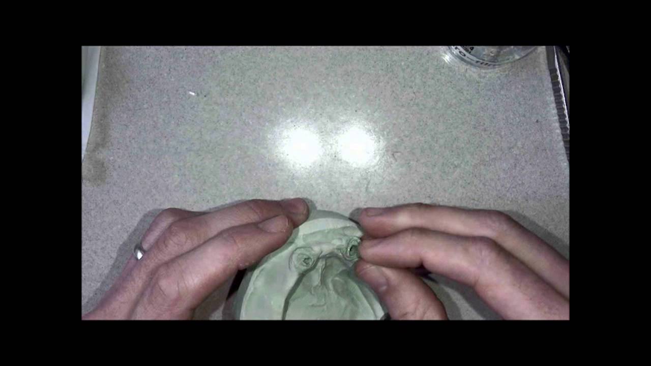 Precision attachment retained overdentures - Part 1 - YouTube