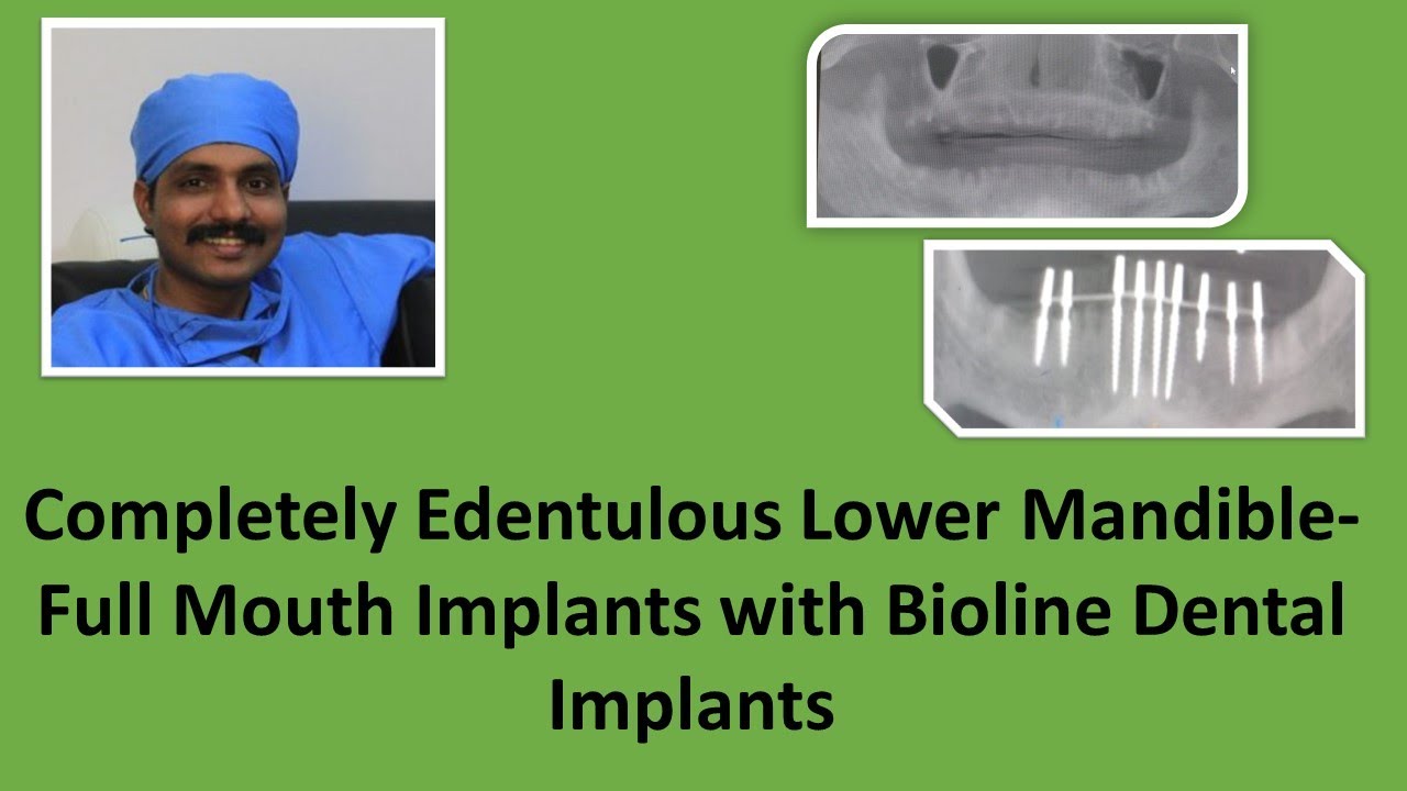 Completely Edentulous Lower Mandible-Full Mouth Implants With Bioline ...