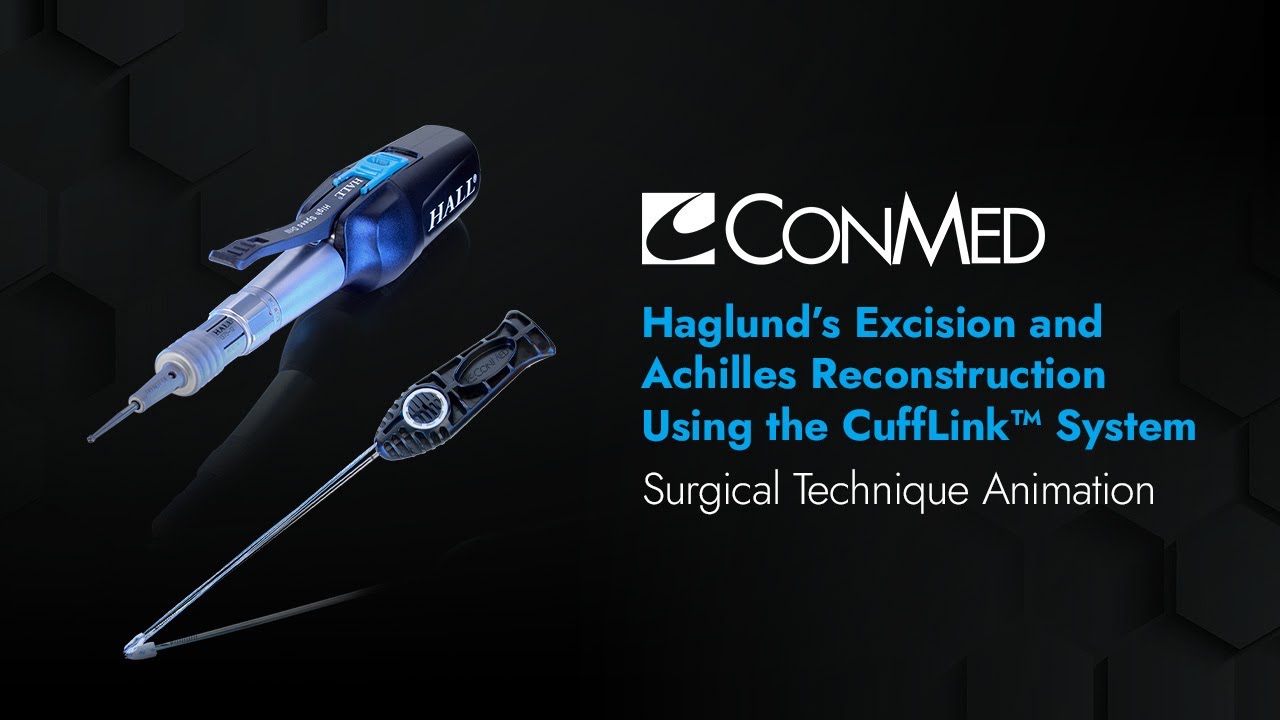 Haglund's Excision and Achilles Reconstruction Using the CuffLink ...