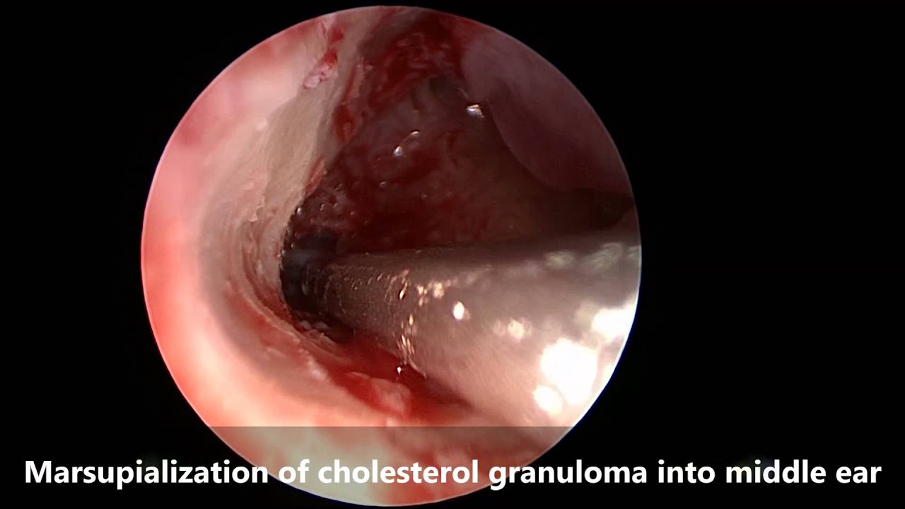Endoscopic infracochlear approach for petrous apex cholesterol ...