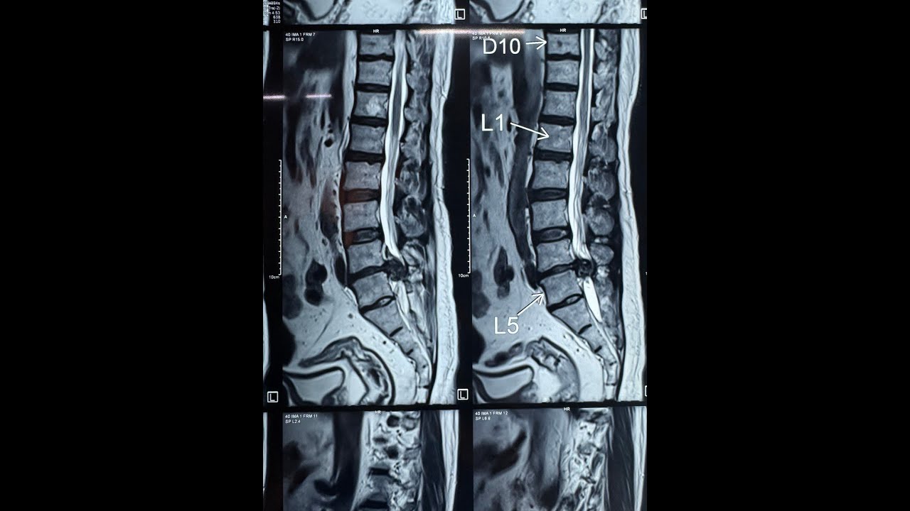 Endoscopic excision of L4-5 extruded disc ( Destandau tech) - YouTube
