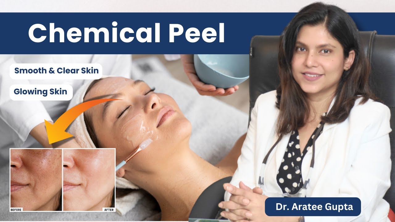 Chemical Peel Treatment for Glowing Skin | Best Peel for Acne ...