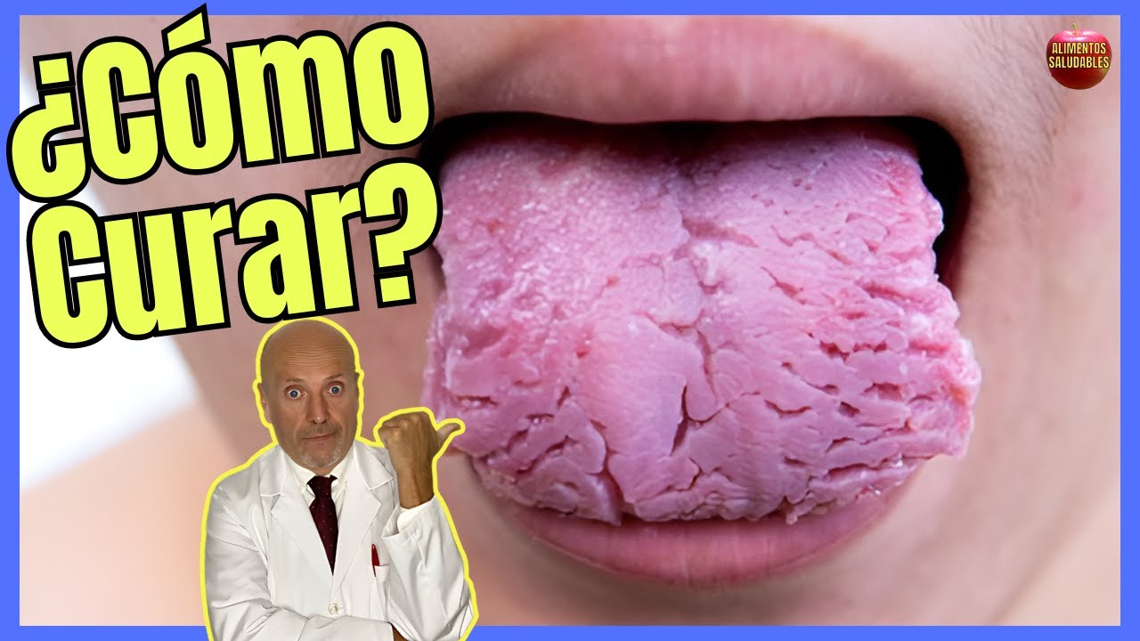 🆘 ¿COMO CURAR LA LENGUA AGRIETADA CON REMEDIOS CASEROS? 🆘 - YouTube