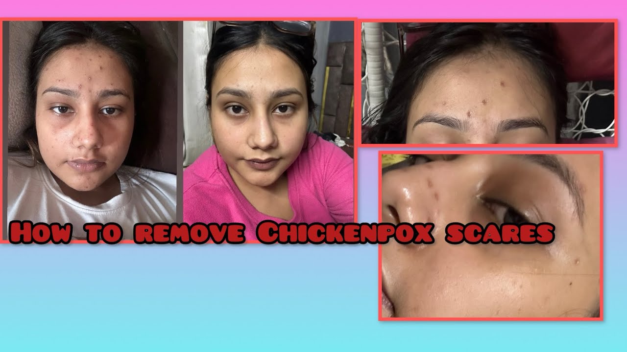 How to remove chickenpox scars 🤝 - YouTube