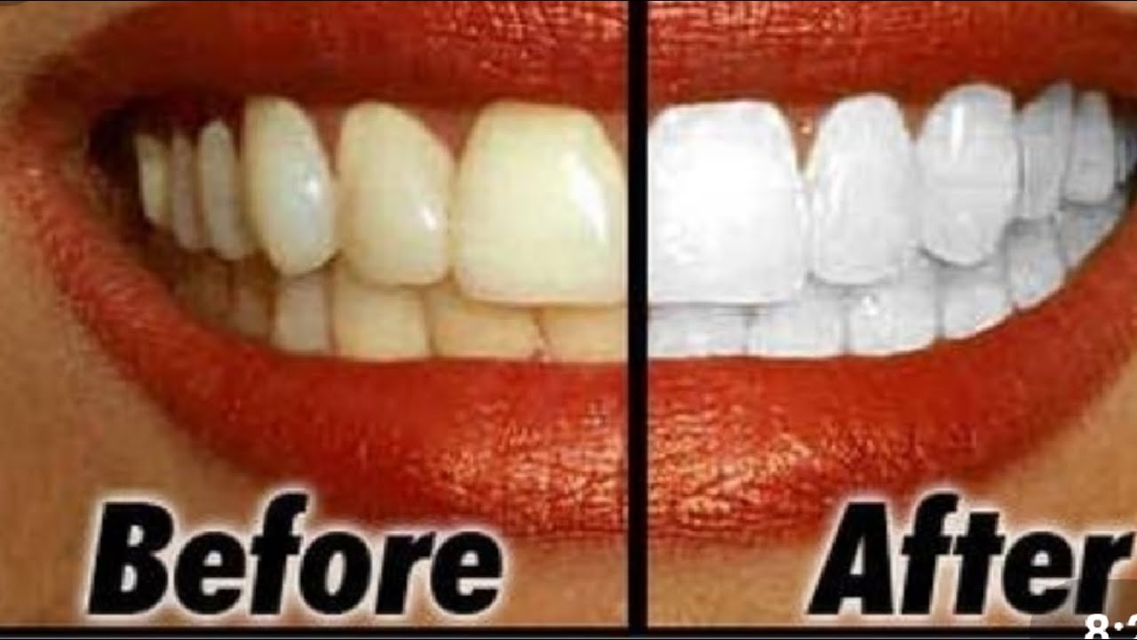 How to get rid of tooth cavity,mouth smell tartar whiten ur teeth 2 ...