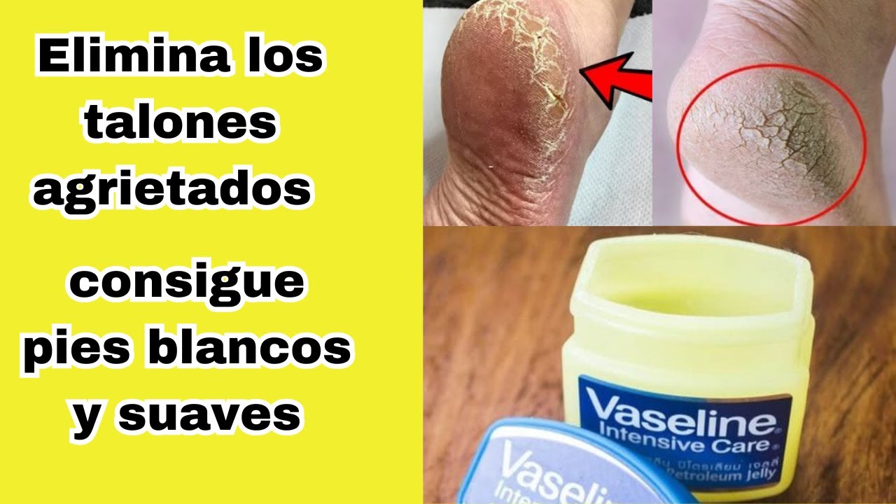 ELIMINA TALONES Agrietados y Resecos/ Pies Blancos y Suaves en 1 Semana ...