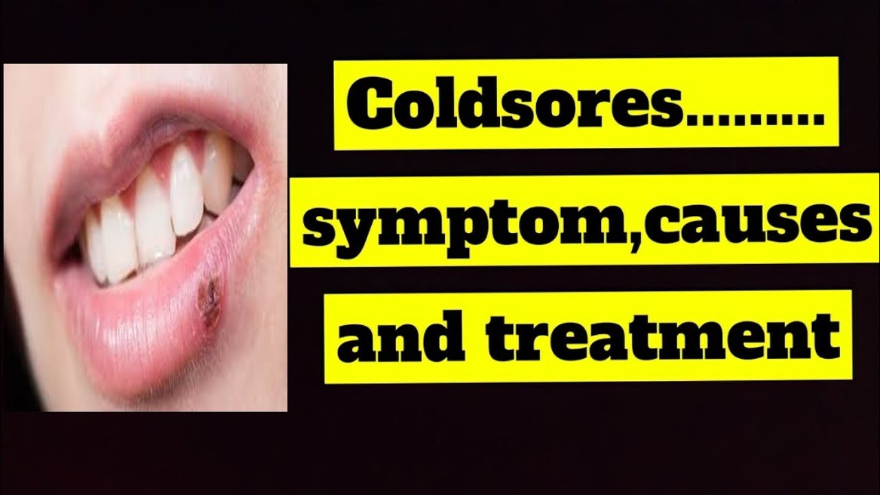 Cold Sores-Symptoms,Causes and Treatment - YouTube