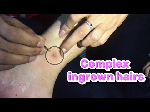 Ingrown hairs are so complicated that I can't find what I'm looking for ...