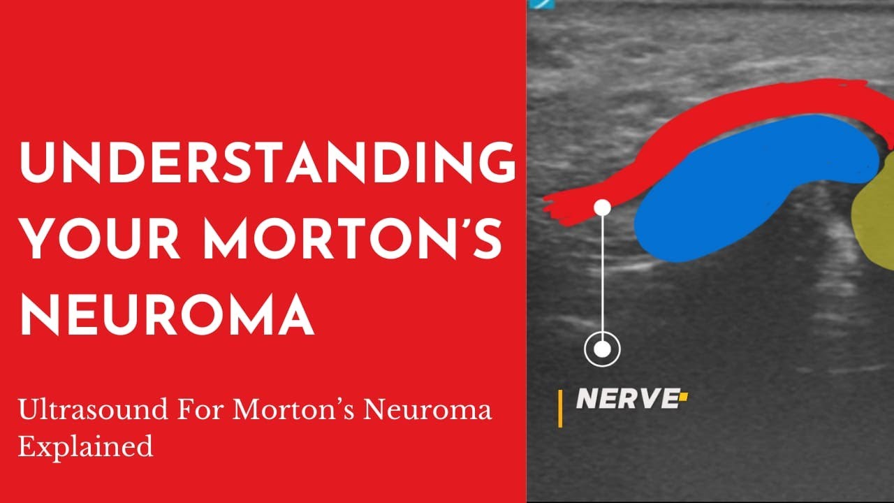 Ultrasound for Morton's Neuroma - YouTube
