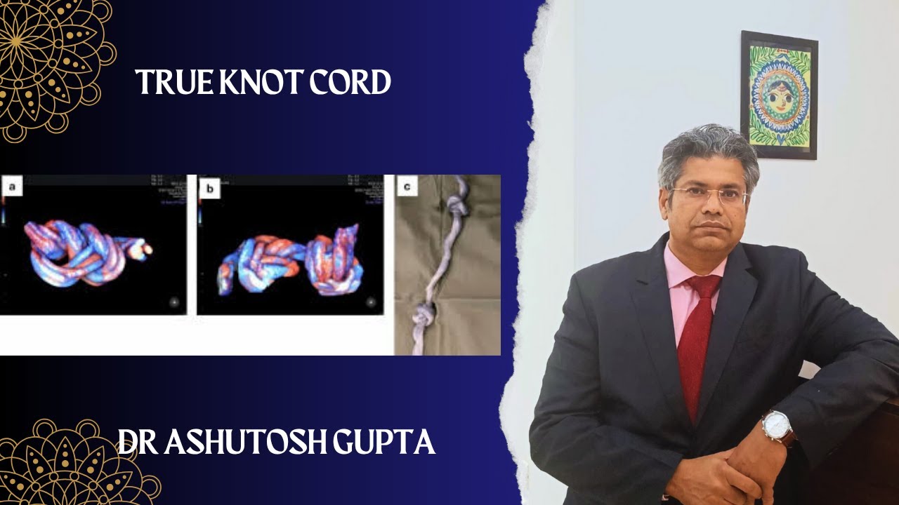True Knot in Umbilical Cord & Management - YouTube