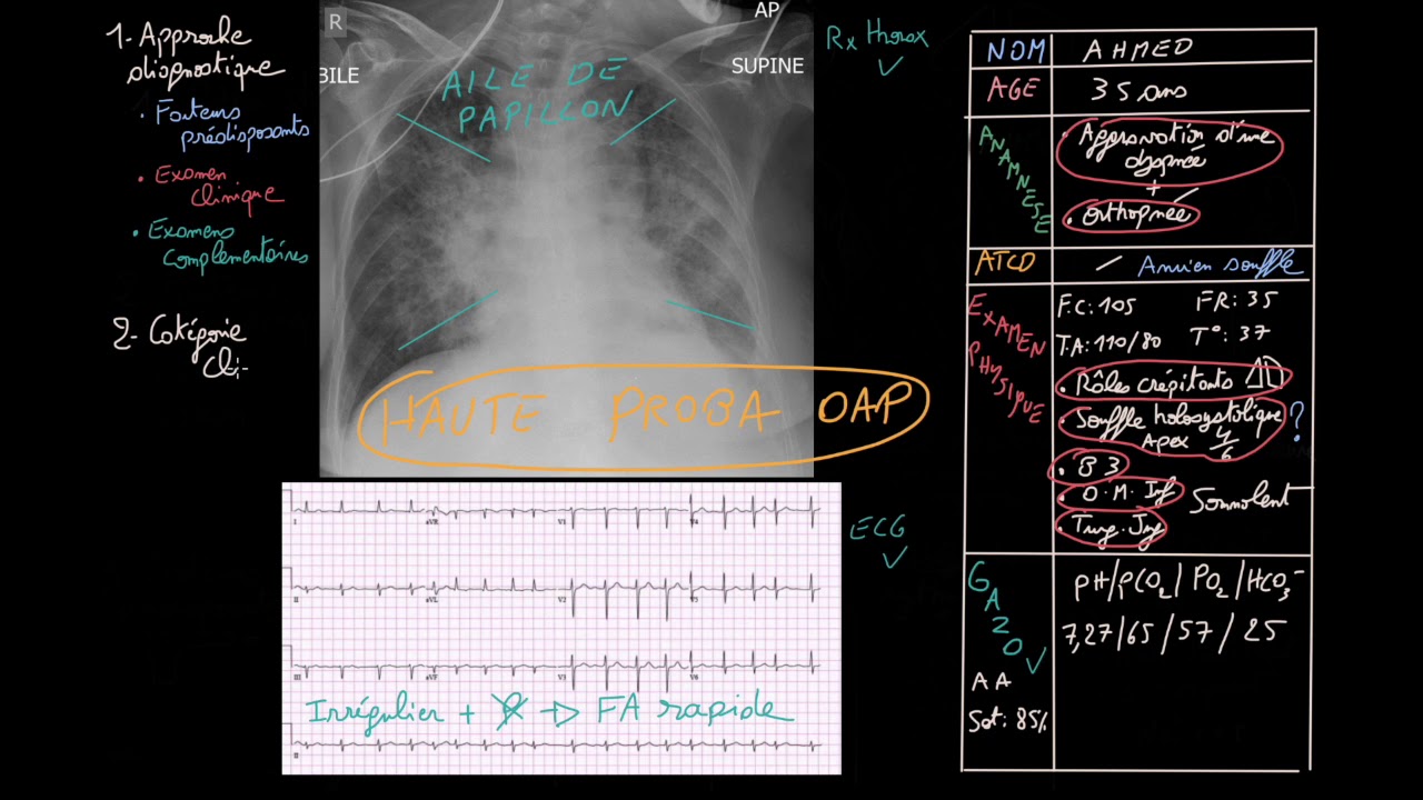 Insuffisance cardiaque aigue - Partie 2 - Docteur Synapse - YouTube
