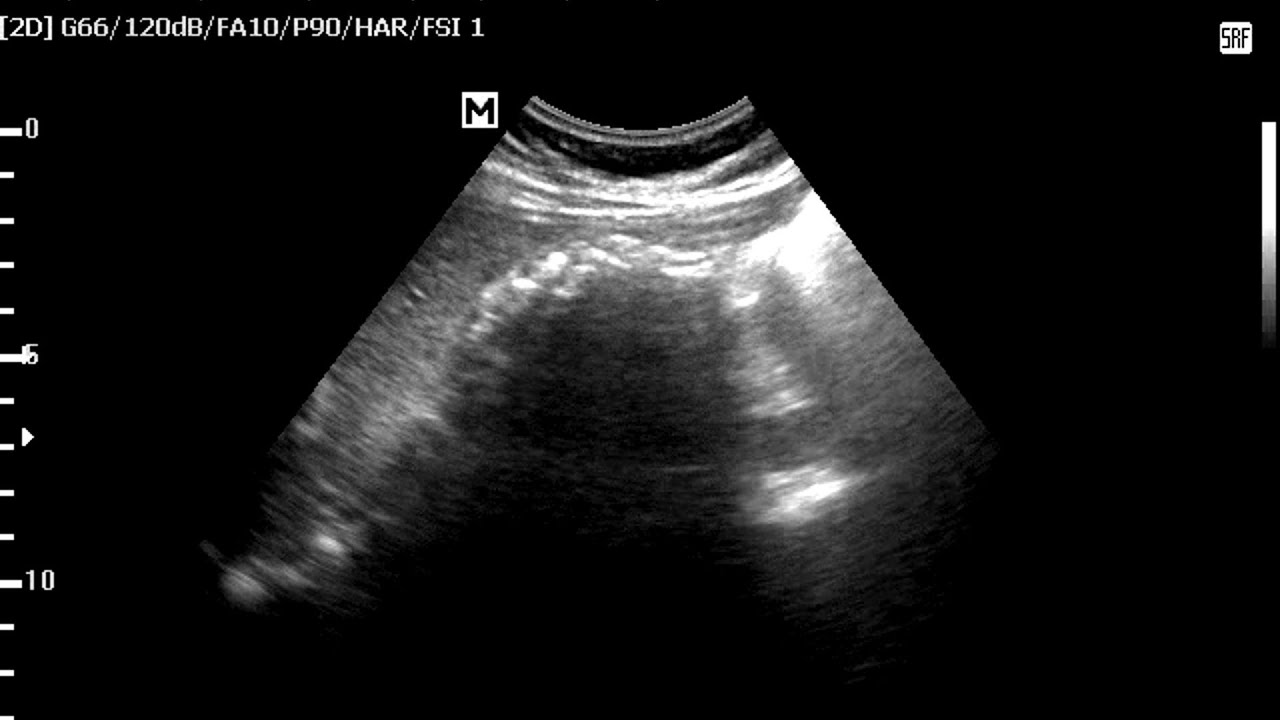 Ultrasound cases 217 of 2000 || Cholelithiasis and WES Sign - YouTube