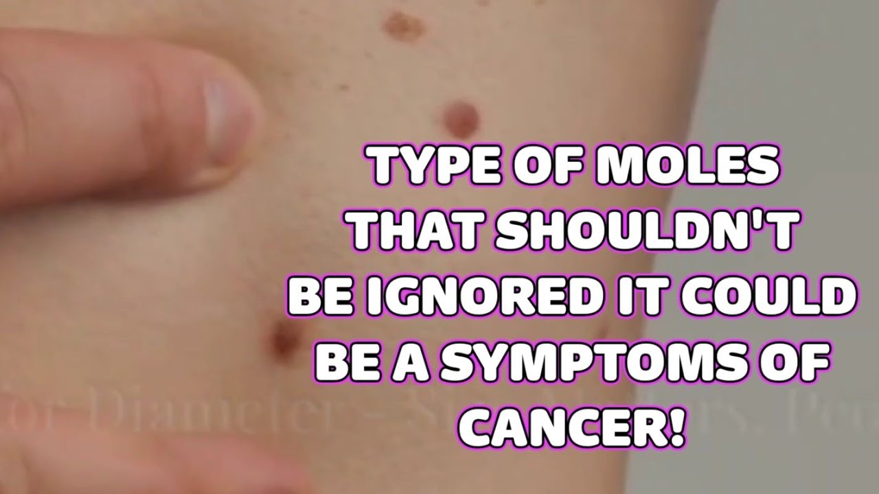 Warning Signs of Moles You Should NEVER Ignore - YouTube