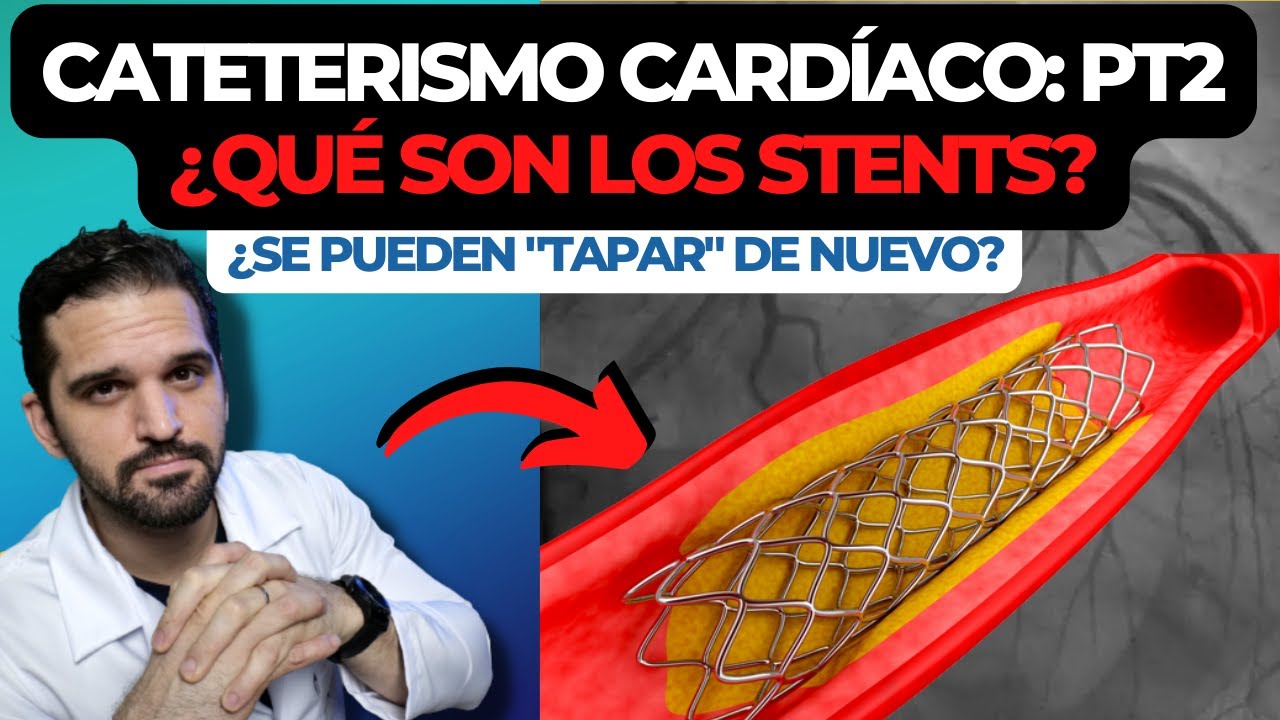 QUÉ SON LOS STENTS CORONARIOS.¿PARA QUE SIRVEN Y DURACIÓN?🤔 - YouTube