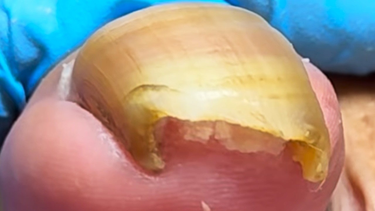 Yellow, Inflamed Ingrown Toenail; Cut Off Any Excess Nail【Xue Yidao ...