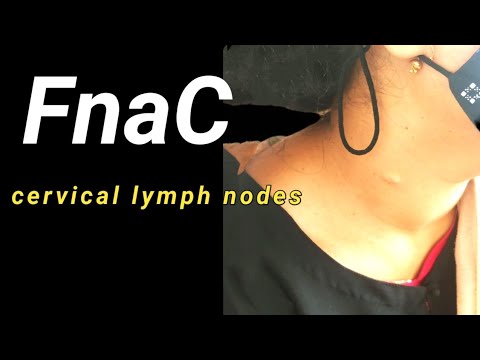 FNAC OF CERVICAL LYMPH NODE।। - YouTube