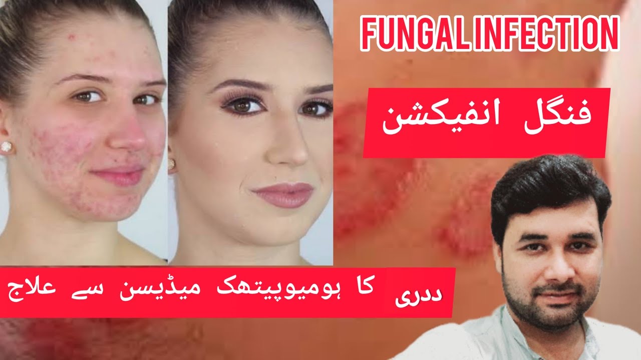 Fungal infection ka permanent ilaj|Dadri ka ilaj kaise kare|Garmi dane ...