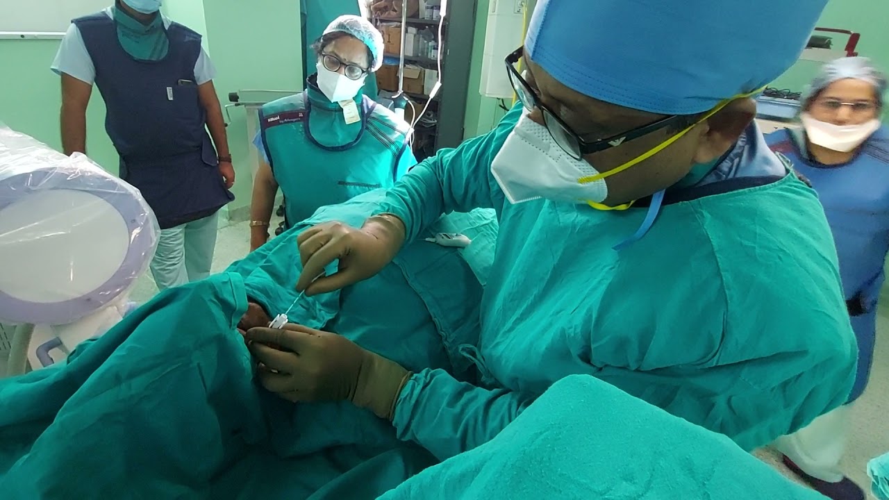 Trigeminal Neuralgia- Percutaneous Balloon Compression, a minimally ...