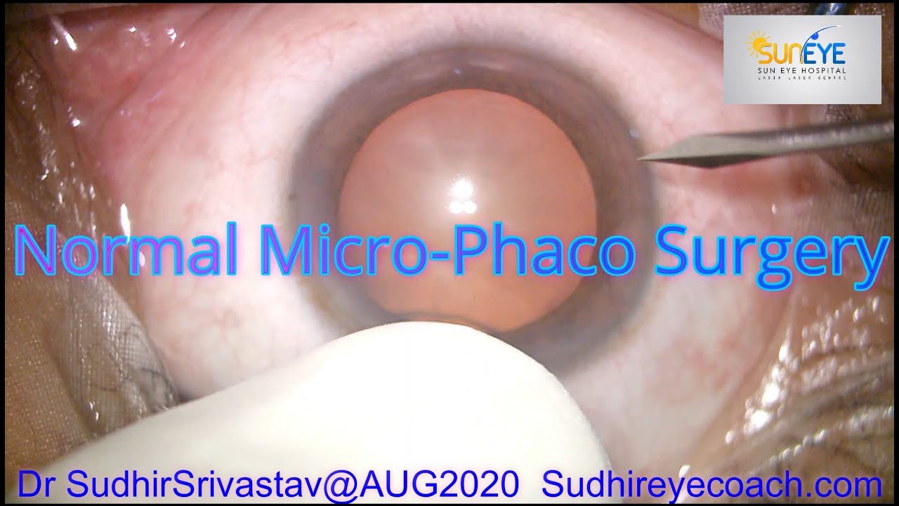 Normal (MICS)Micro-Phacoemulsification Cataract Surgery -DR SUDHIR ...