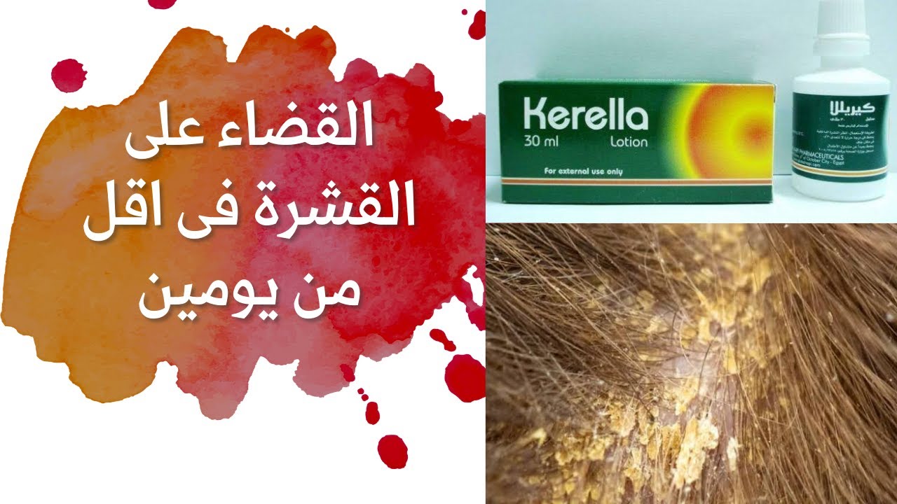 تجربة الناس لاستخدام الكيريلا لوشن لقشرة الشعر صدمة😱ب ١٤ جنيه فقط لعلاج ...