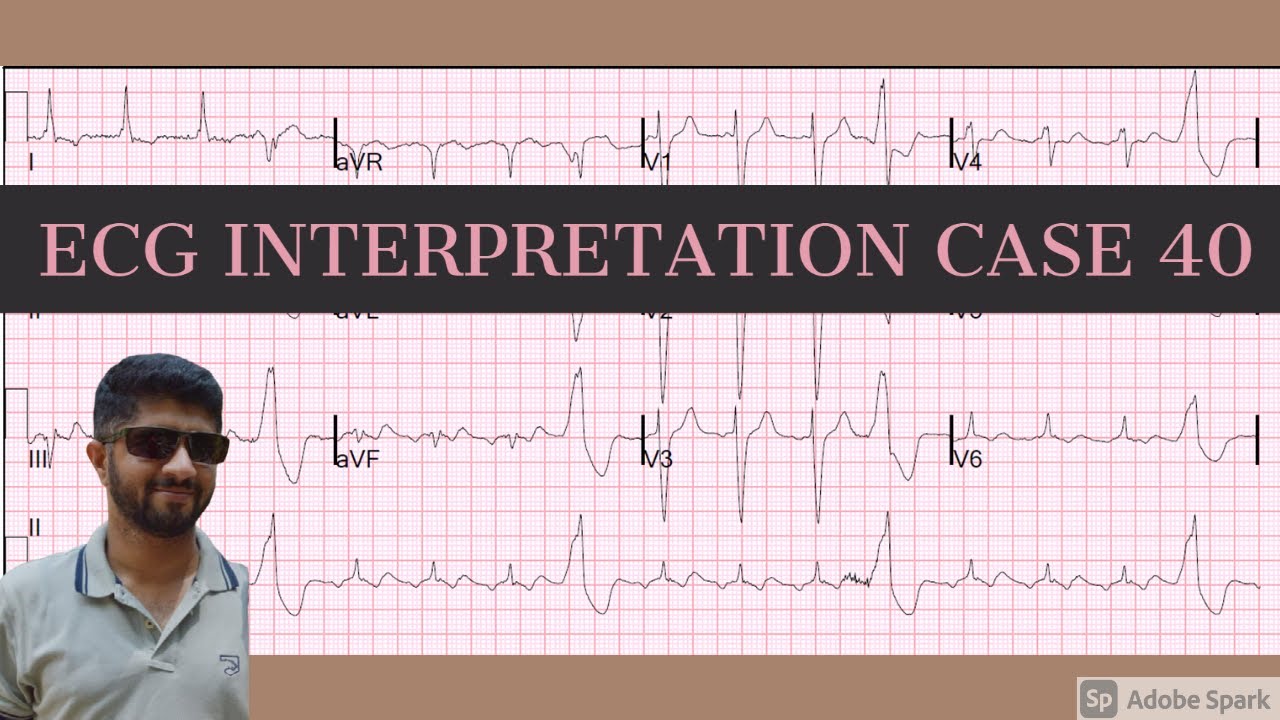 ECG MADE EASY CASE 40| ECG| EKG| ELECTROCARDIOGRAM| EDUCATIONAL VIDEO ...
