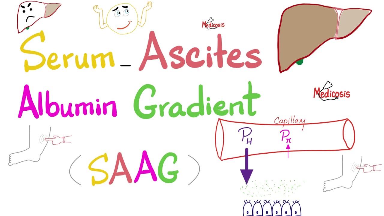 Serum Ascites Albumin Gradient (SAAG) | Peritoneal Effusion | Lab 🧪 ...