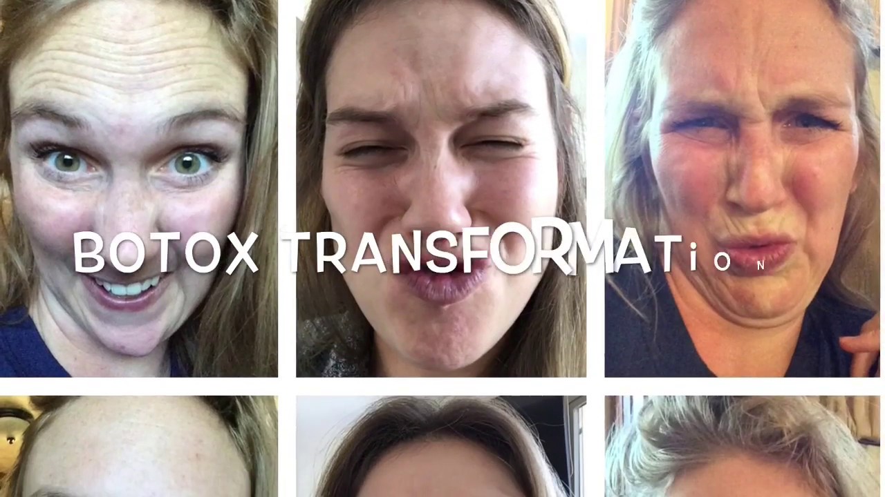 BOTOX TRANSFORMATIONS!!!! Before and After - YouTube