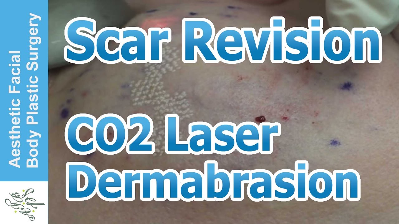 Laser Scar Revision With CO2 Laser Part 02 by Dr. Philip Young Bellevue ...