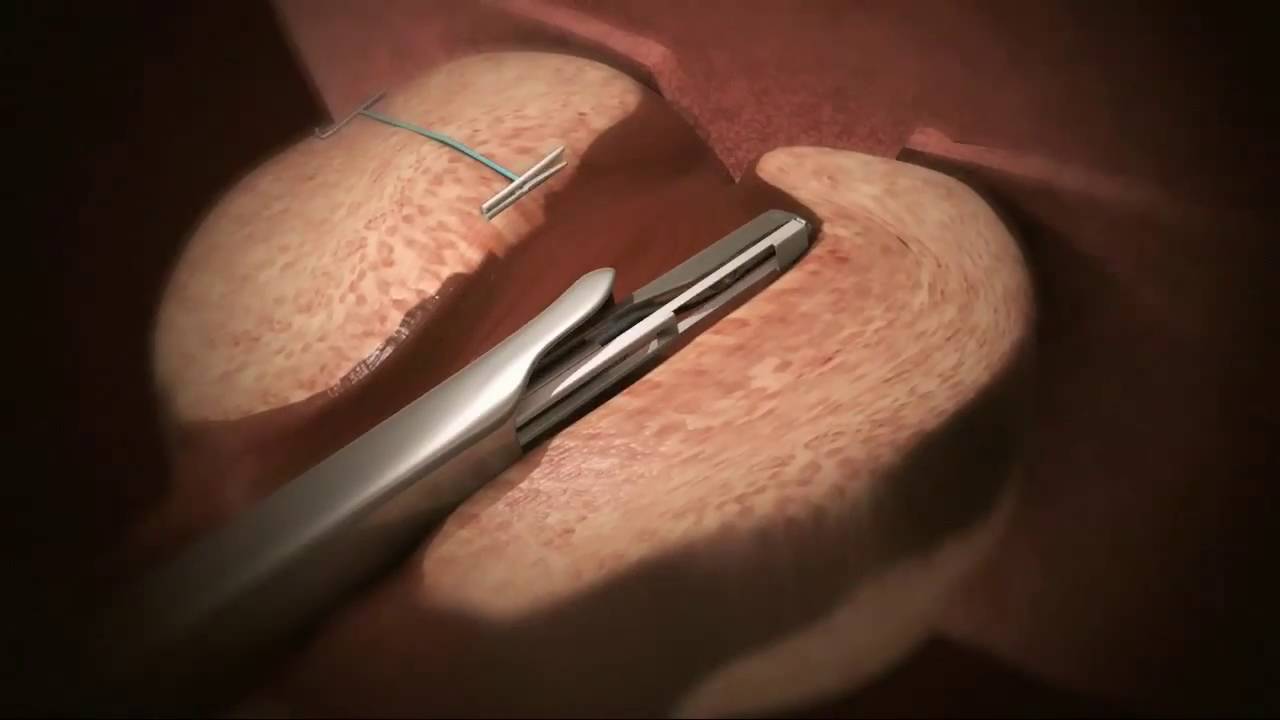 The UroLift® System a minimally invasive enlarged prostate treatment ...