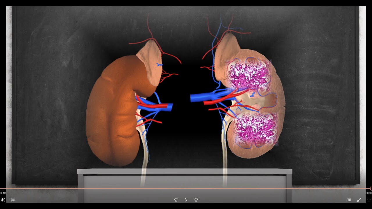 LDL Apheresis in FSGS - YouTube