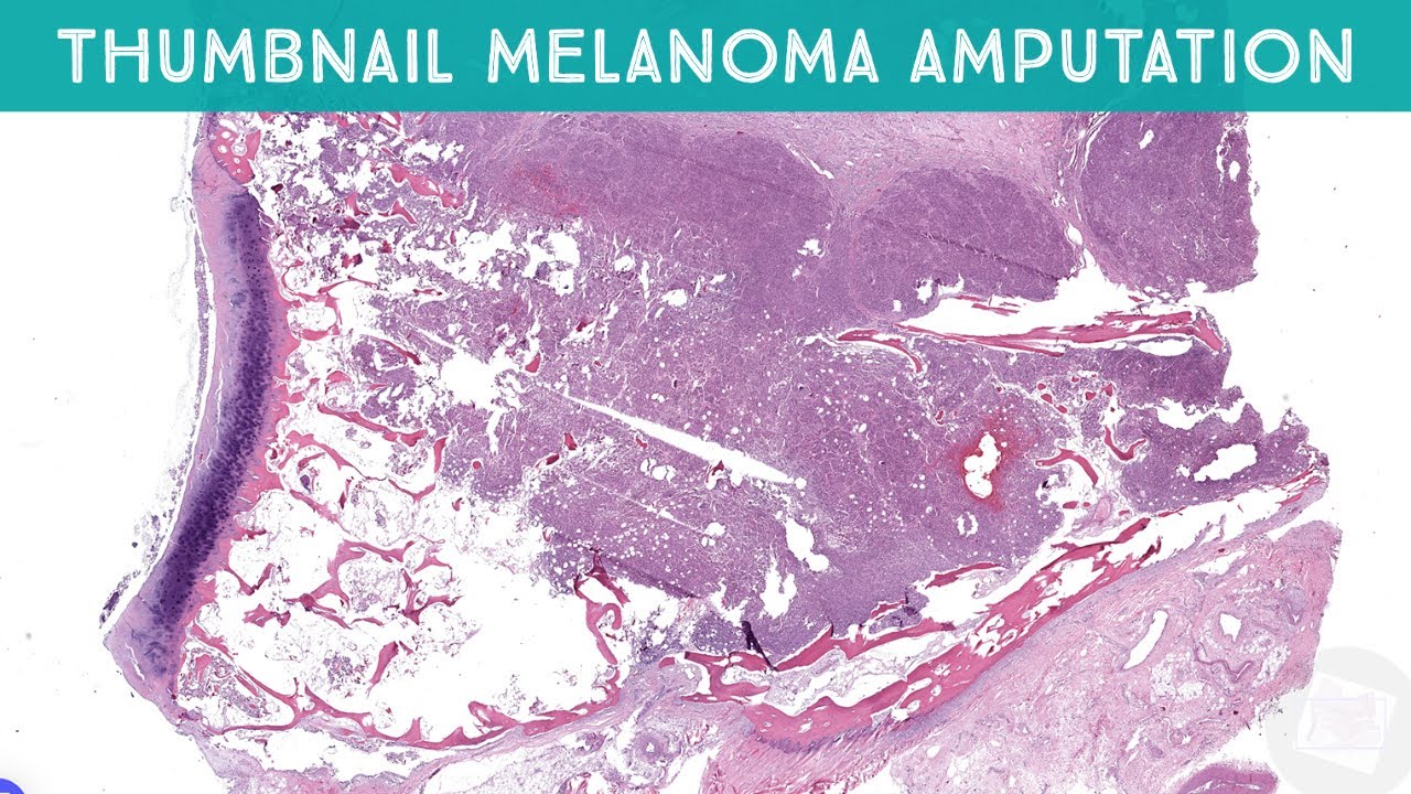 Amputation of Thumbnail Melanoma (subungual melanoma invading bone ...