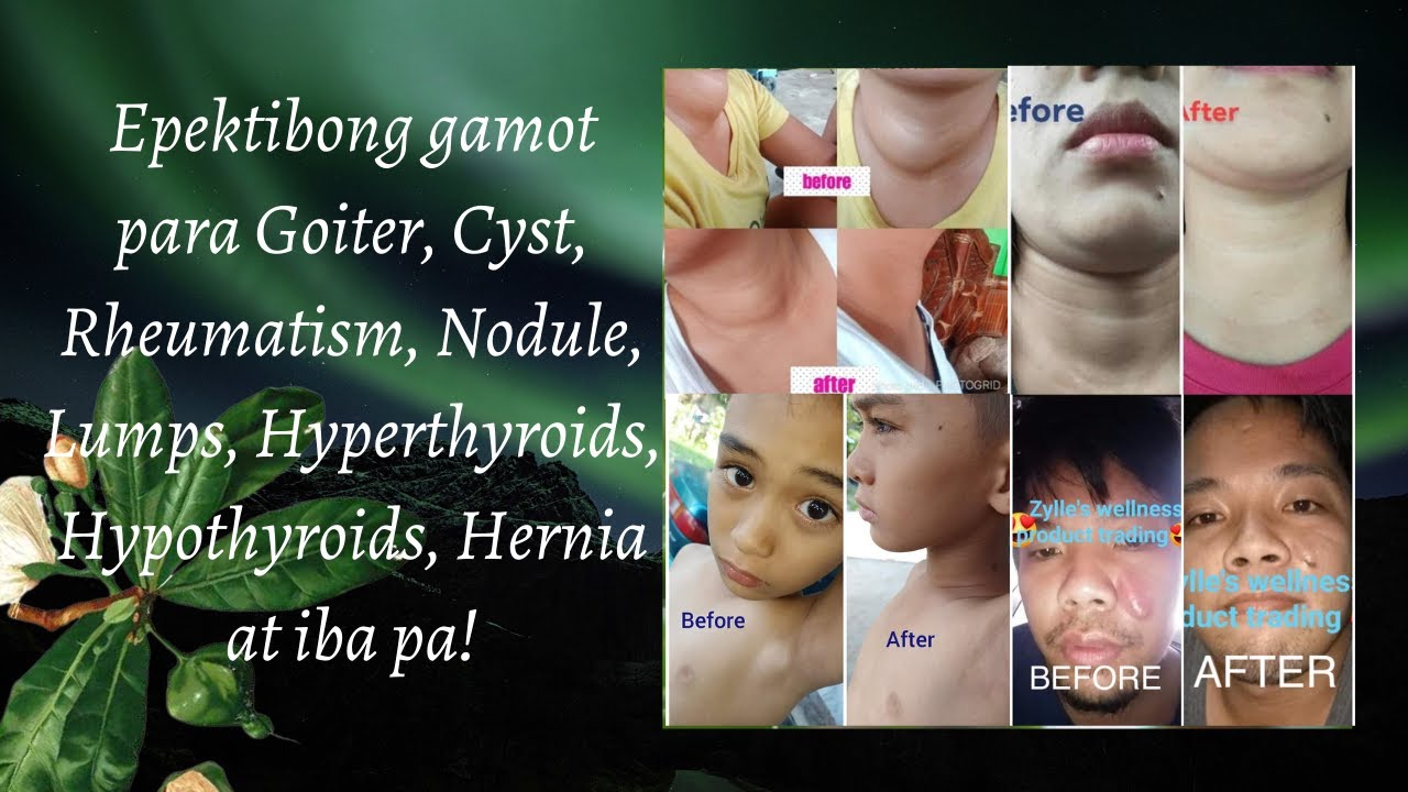 Bitoon Herbal epektibo nga ba sa bukol, goiter, cyst at iba pa. Paano ...
