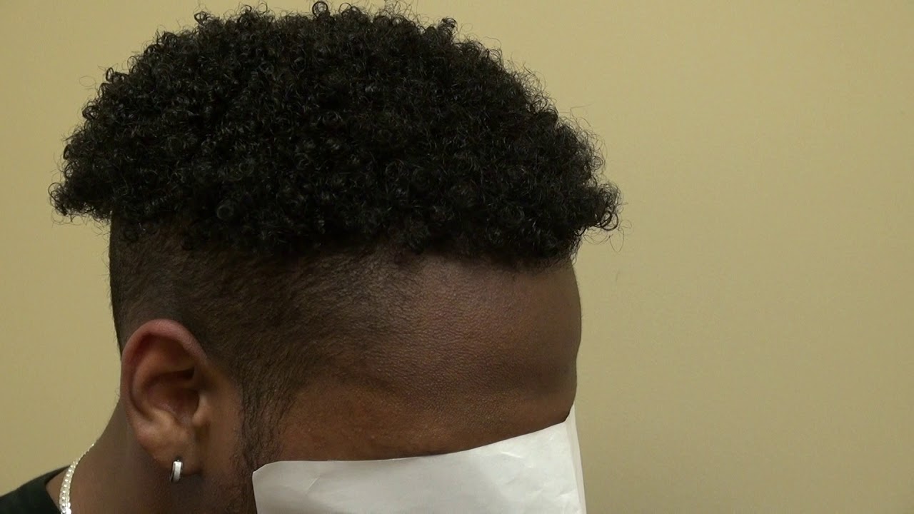Black African Hairline Restoration Hair Transplant Surgery San ...
