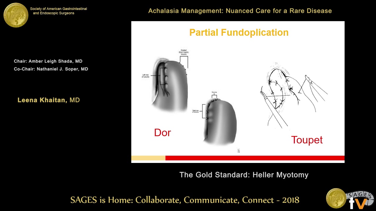 Heller myotomy: The gold standard for achalasia management - YouTube