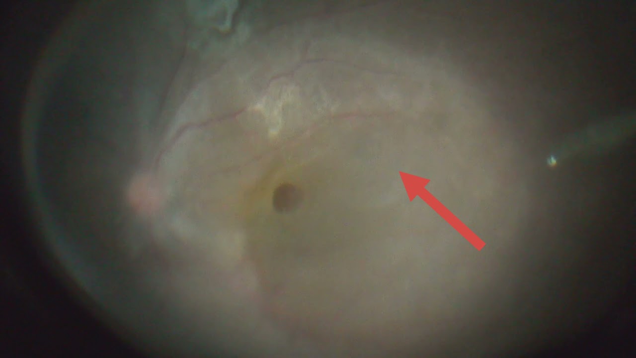 removal of subretinal pfcl bubble - YouTube