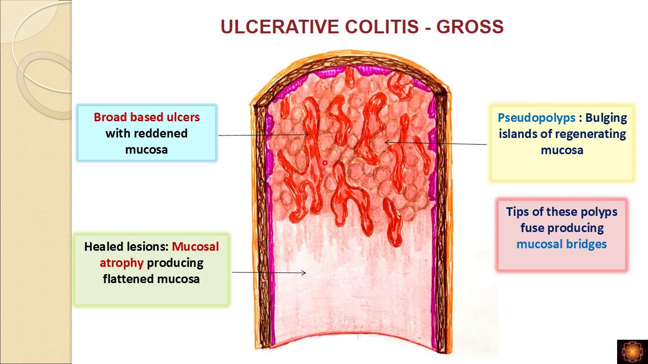 ULCERATIVE COLITIS - MORPHOLOGY - BY DR.V.SHANTHI - YouTube