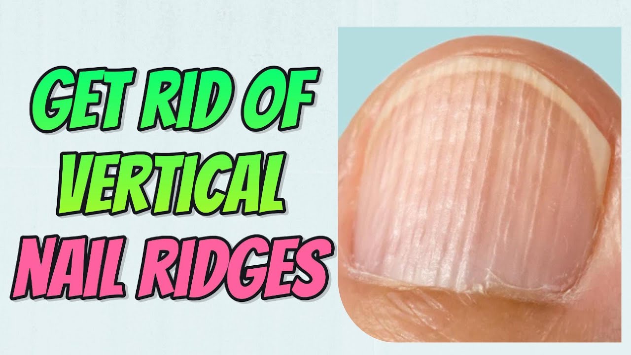 Vertical Nail Ridges: Causes and Remedies Explained - YouTube