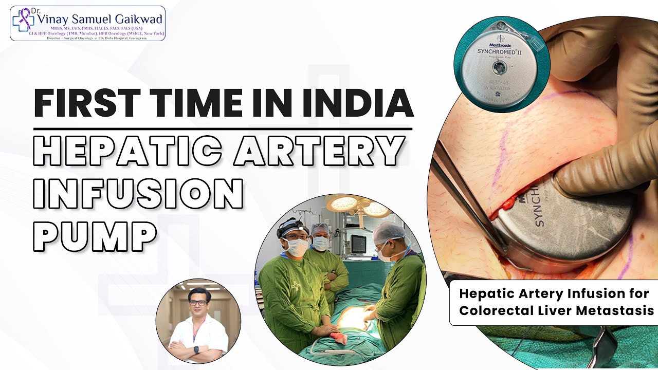 First Time in INDIA - Hepatic Artery Infusion for Colorectal Liver - Dr ...