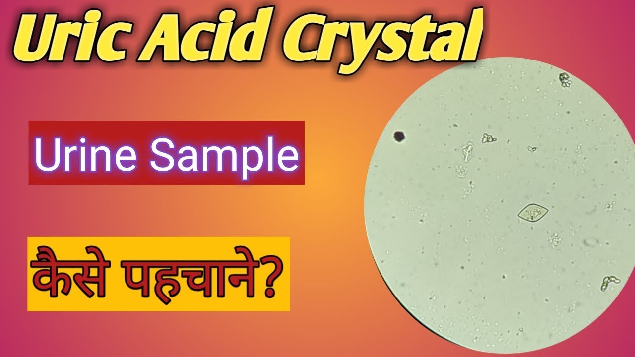 Uric acid crystal | Uric acid crystal in urine | uric acid crystal ...