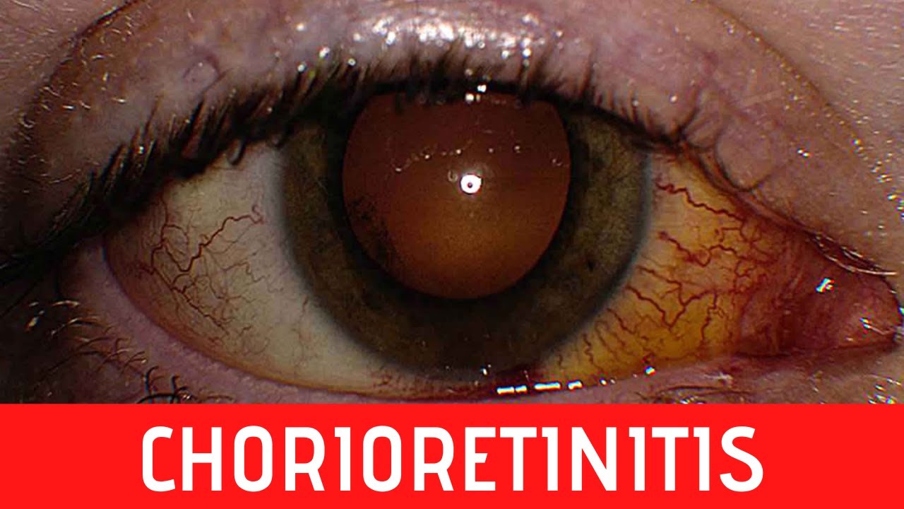 Chorioretinitis