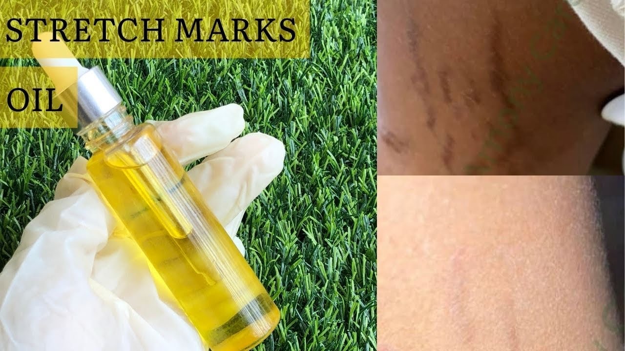 CLEAR STRETCH MARKS FAST😱| HOW TO MAKE STRETCH MARKS ERASER OIL FOR ...