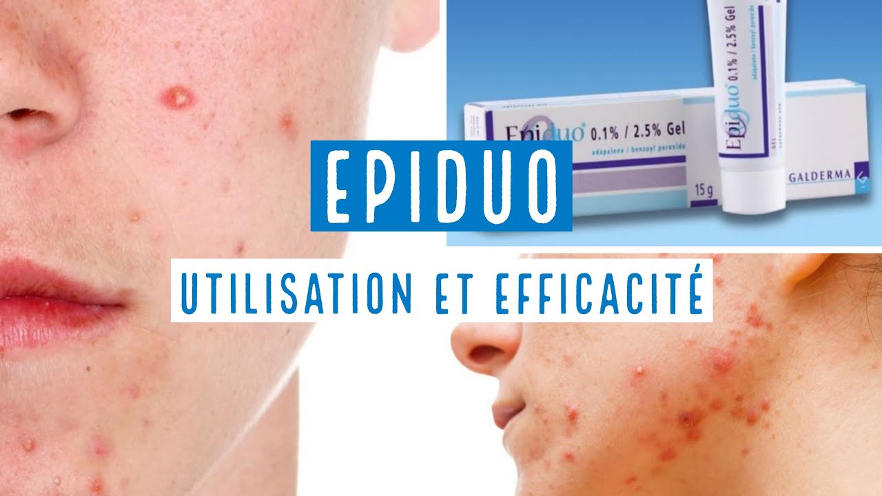 EPIDUO 0.1/2.5 % GEL - YouTube