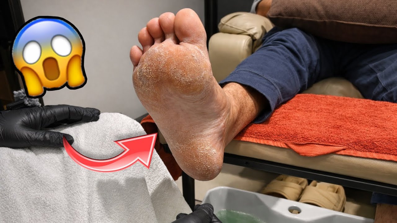Huge Foot Condition Cleaned | So Satisfying 😳 | Massive Callus & Thick ...