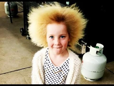 6 People With Uncombable Hair Syndrome - YouTube