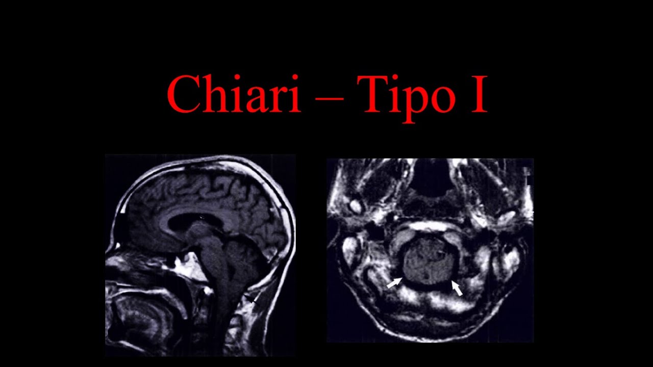 Chiari Tipo I - Malformação (Neuroradiologia) - YouTube